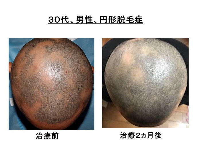 遠隔診療で治療中の円形脱毛症が、治療2ヵ月で明らかに改善！ 患者様からの声・メディア掲載・クリニックからのお知らせ 名古屋kクリニック